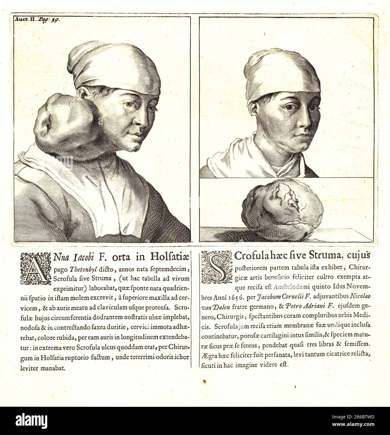 Medicine, Anatomy, Anneke Jacobs van Thetenbul before and after surgery ...