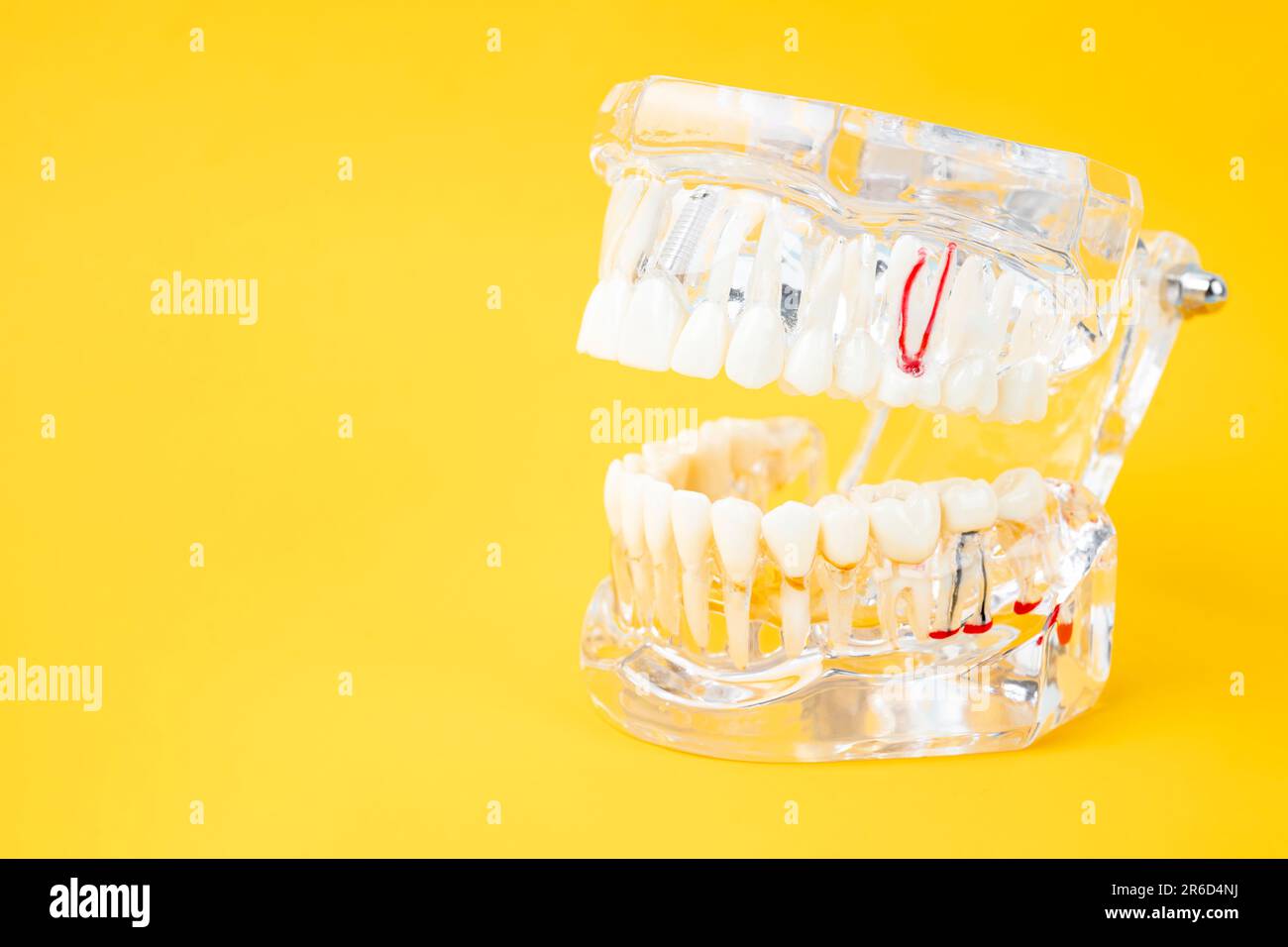 Transparent tooth model with dental implant on yellow background Stock ...