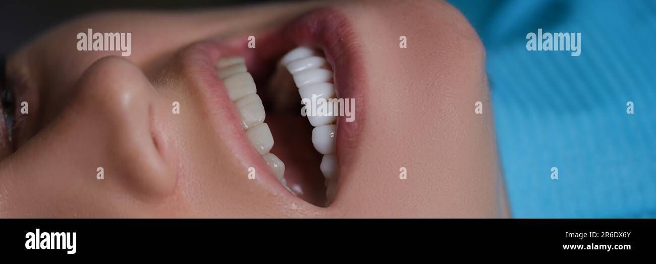 Patient with open mouth with veneers on lower jaw at visit at dentist ...