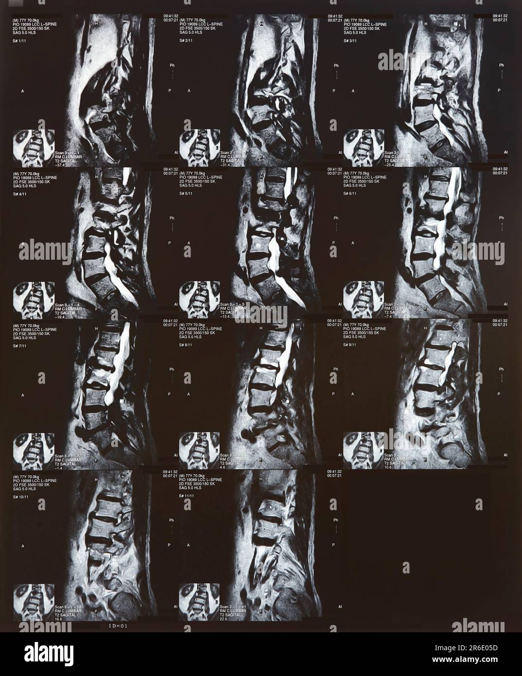 Magnetic resonance imaging. Spinal column detail. Medical procedure ...
