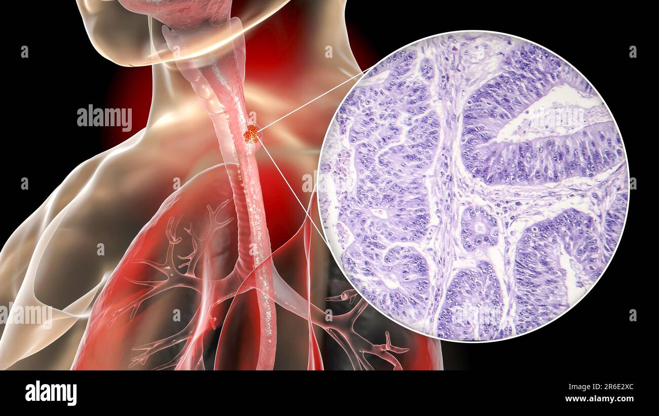 Esophagus gullet oesophagus hi-res stock photography and images - Alamy