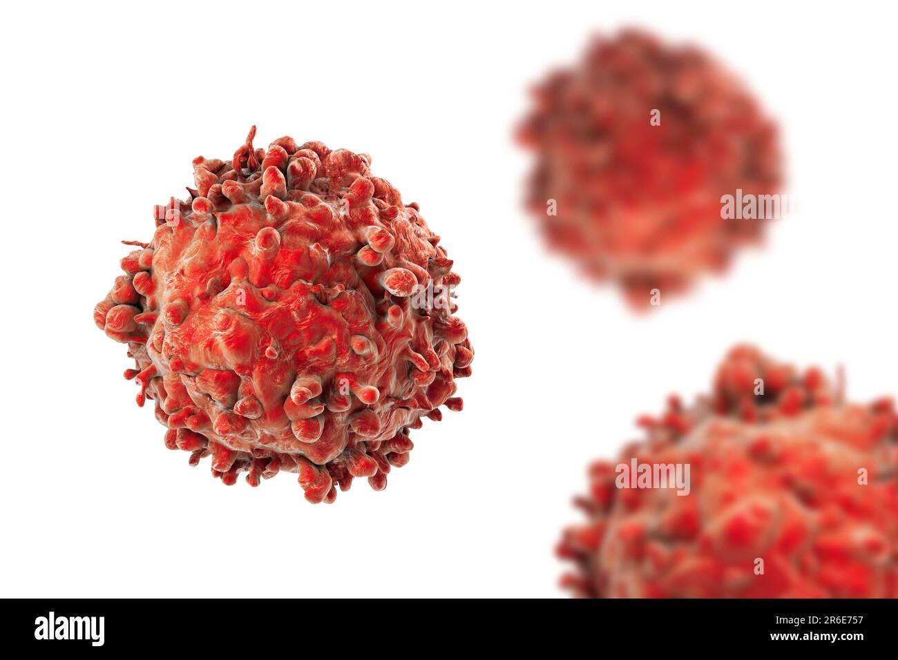 Computer illustration of a cancerous white blood cell in leukaemia ...