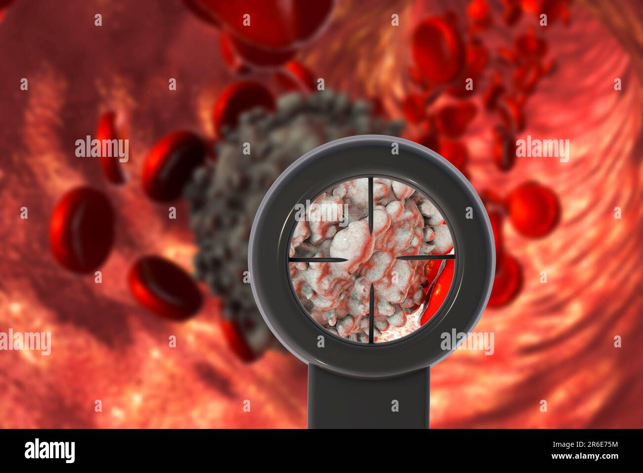 Treatment of leukaemia. Conceptual illustration showing optical sight ...