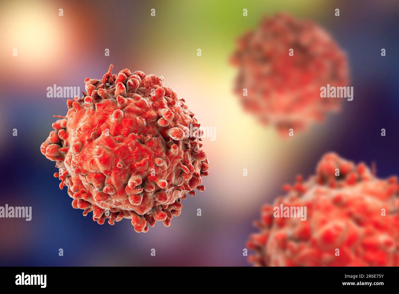 Computer illustration of a cancerous white blood cell in leukaemia ...