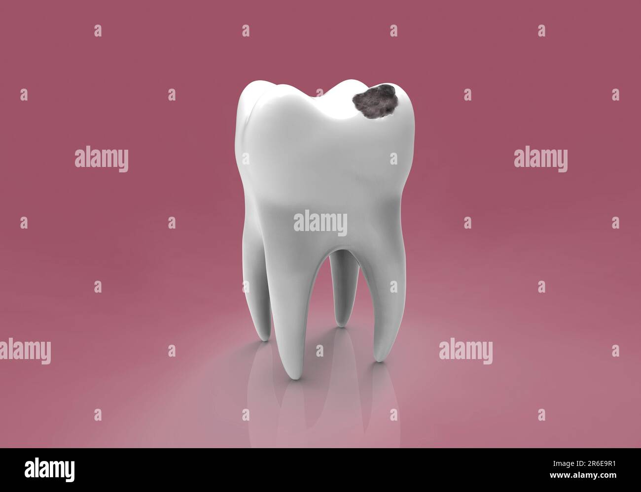 Tooth decay. Computer artwork of a tooth with cavity Stock Photo - Alamy