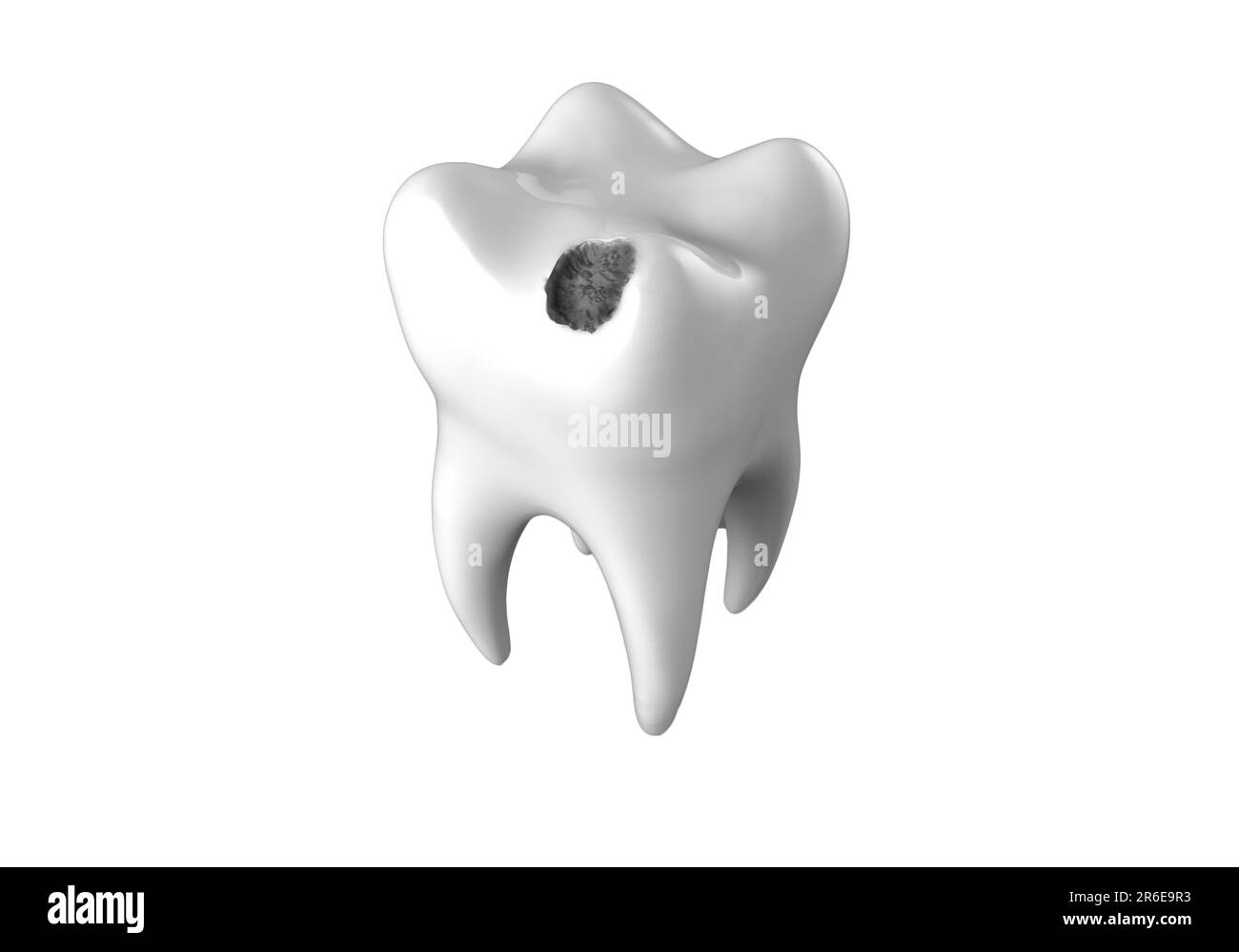 Tooth decay. Computer artwork of a tooth with cavity Stock Photo - Alamy