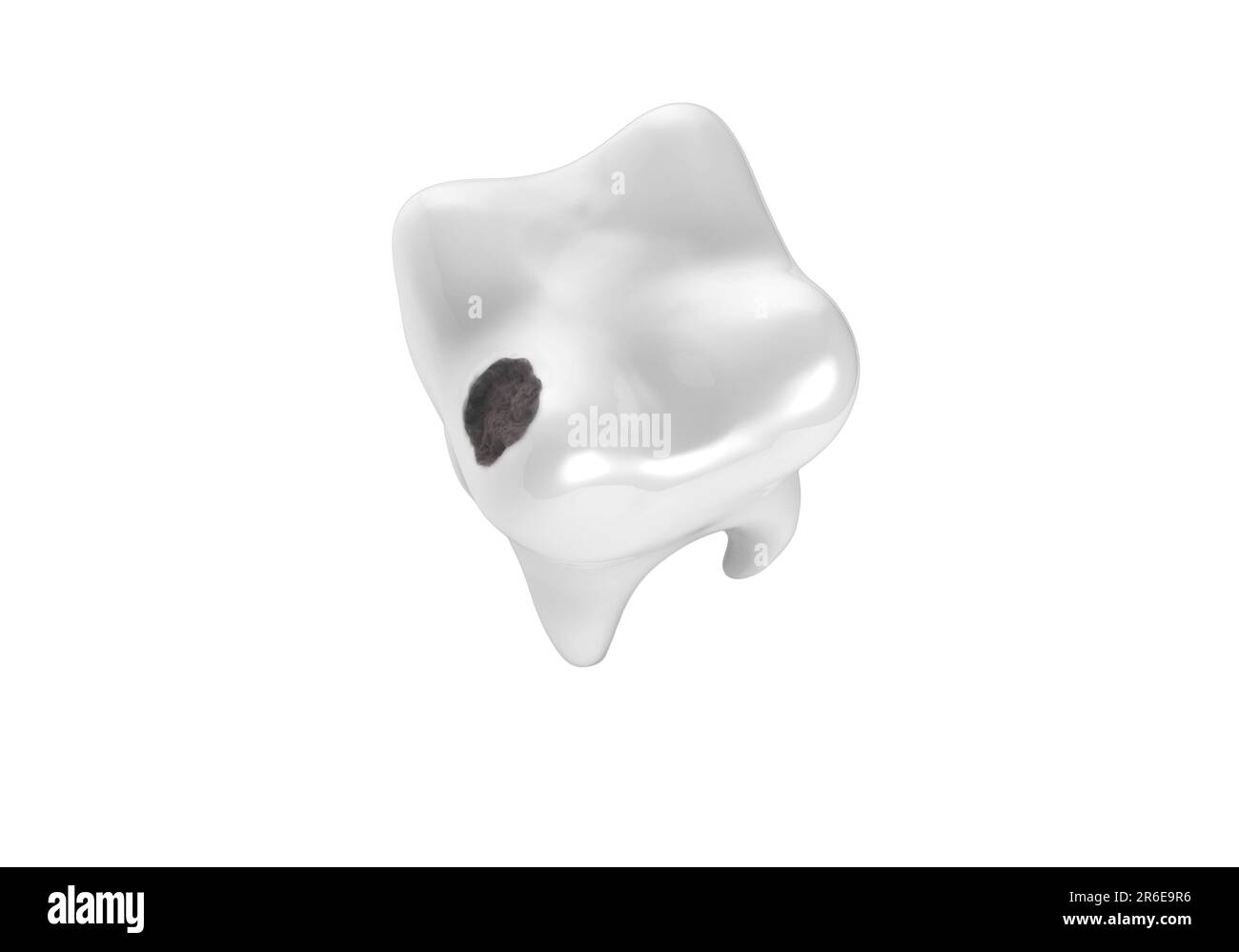 Tooth decay. Computer artwork of a tooth with cavity Stock Photo - Alamy