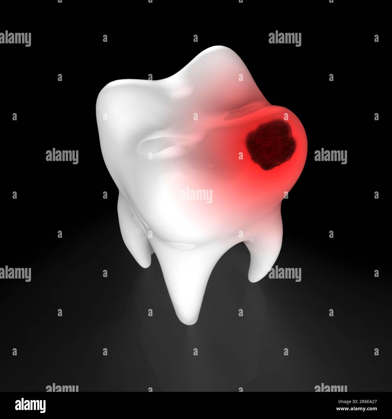 Tooth decay. Computer artwork of a tooth with cavity Stock Photo - Alamy