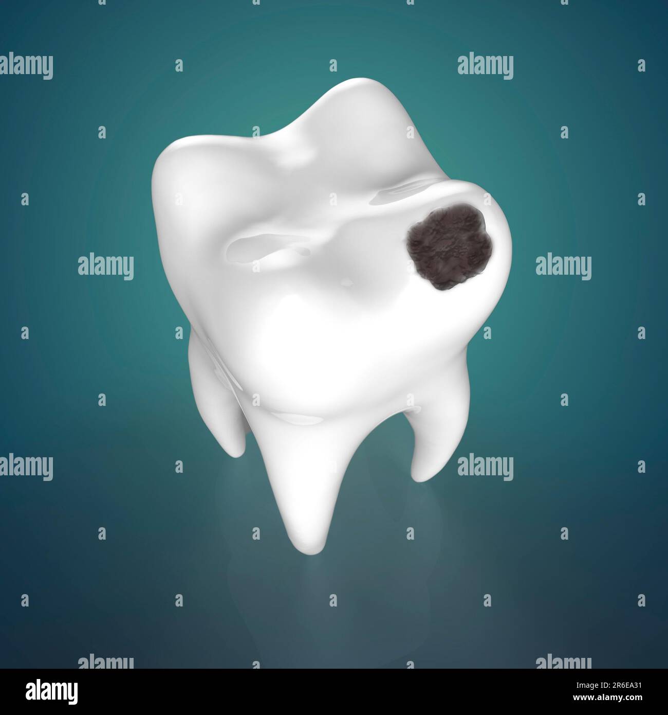 Tooth decay. Computer artwork of a tooth with cavity Stock Photo - Alamy