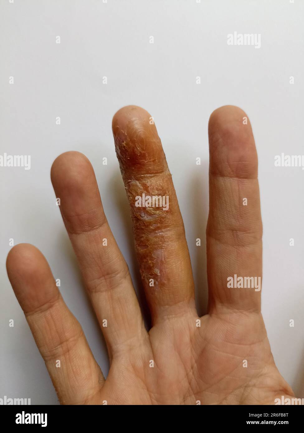 rash eczema dermatitis on hand. inflammation of skin Stock Photo - Alamy