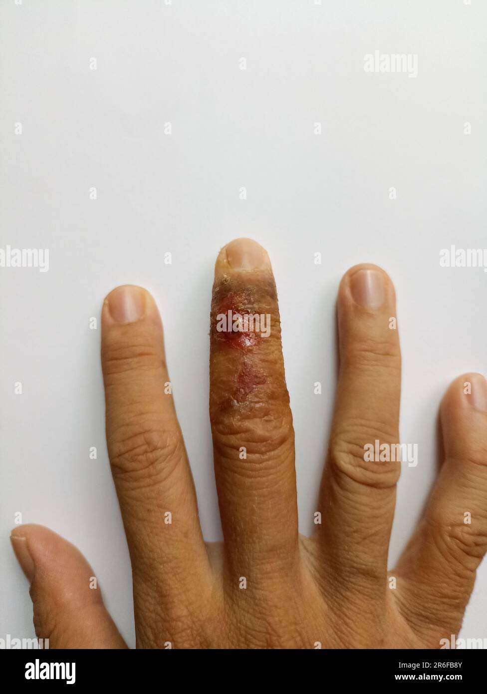 rash eczema dermatitis on hand. inflammation of skin Stock Photo - Alamy