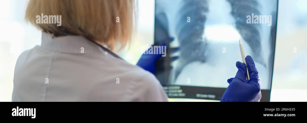 Doctor pulmonologist examining x-ray photograph of lungs Stock Photo ...