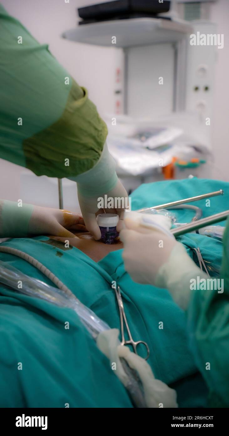 Obesity surgery. Weight loss surgery with laparoscopy technique Stock ...