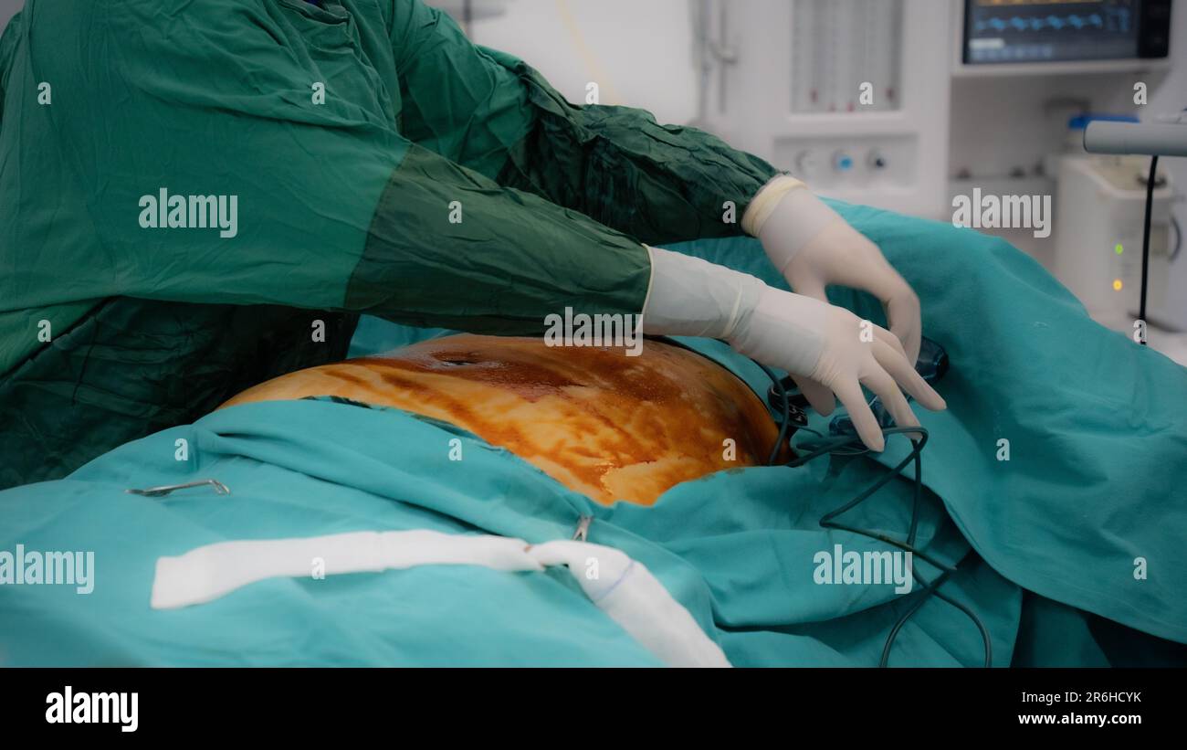 Obesity surgery. Woman preparing for obesity surgery. Before the ...