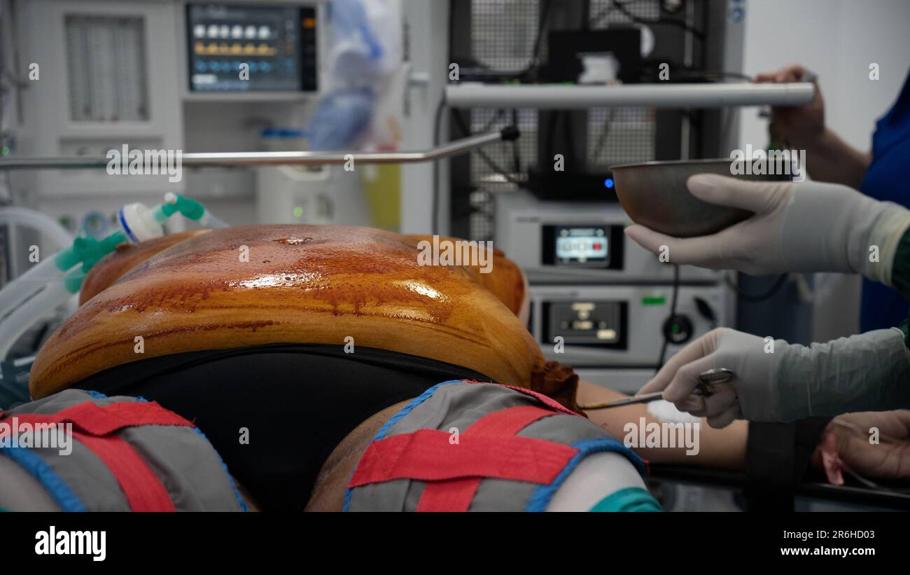 Obesity surgery. Woman preparing for obesity surgery. Before the ...