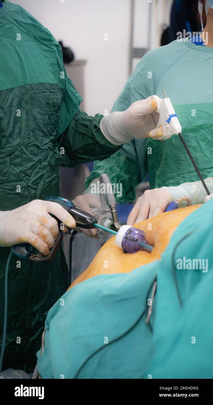 Obesity surgery. Weight loss surgery with laparoscopy technique Stock ...