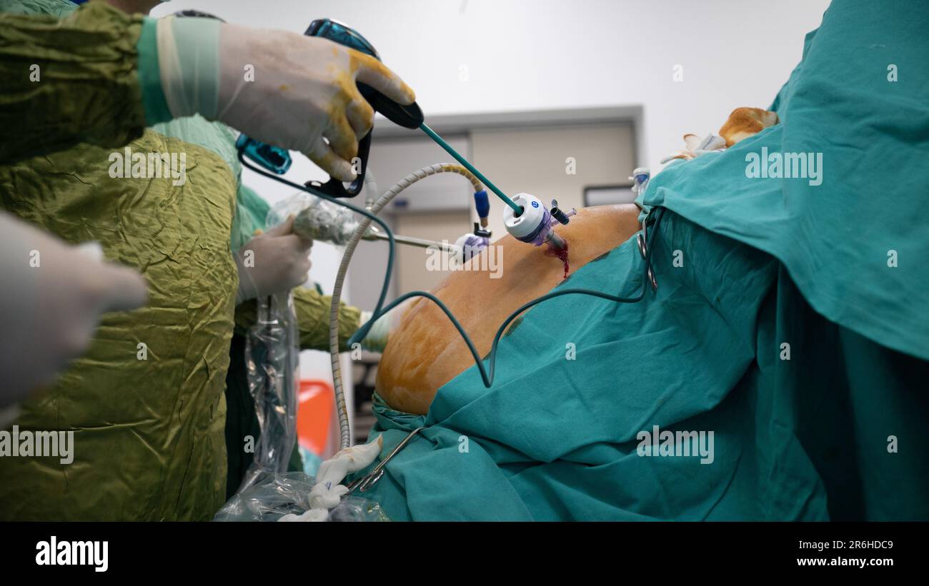 Obesity surgery. Weight loss surgery with laparoscopy technique Stock Photo - Alamy