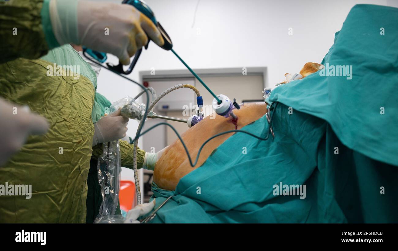 Obesity surgery. Weight loss surgery with laparoscopy technique Stock ...