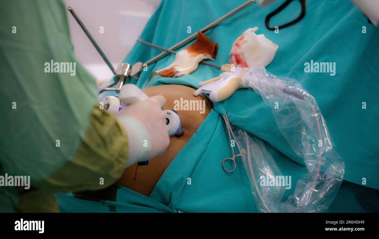 Obesity surgery. Weight loss surgery with laparoscopy technique Stock ...