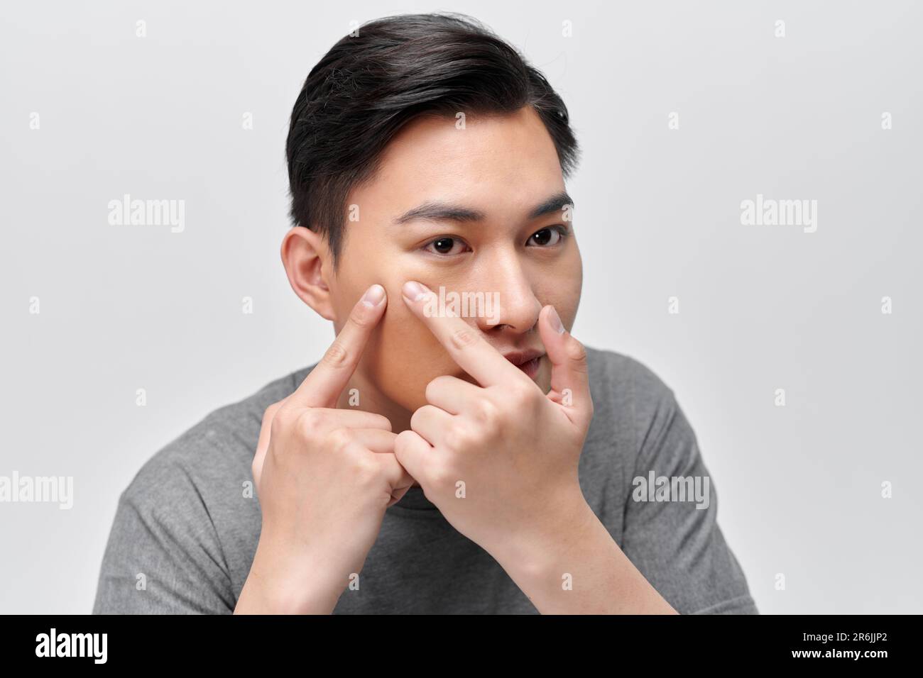 handsome young man Squeezing pimple Stock Photo - Alamy