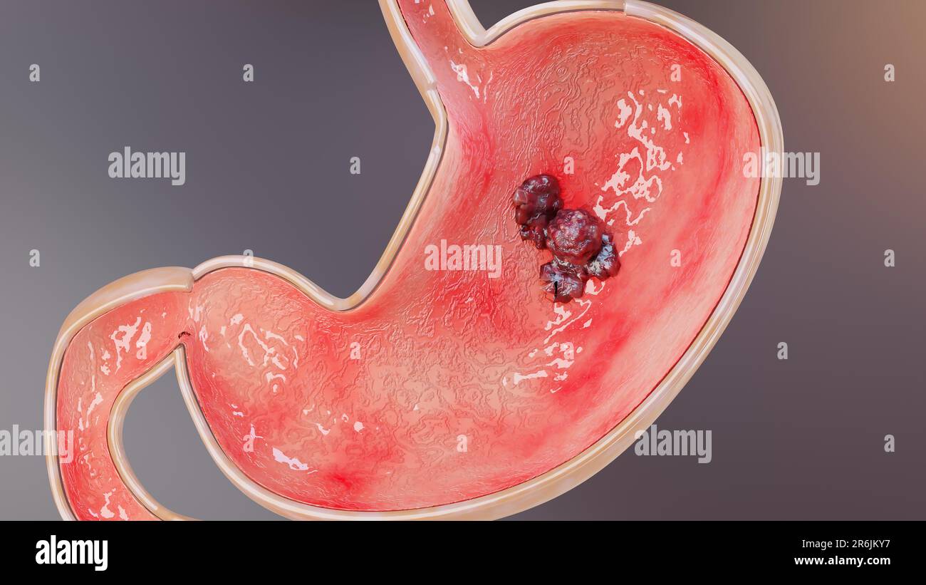 Gastric Cancer Diagram