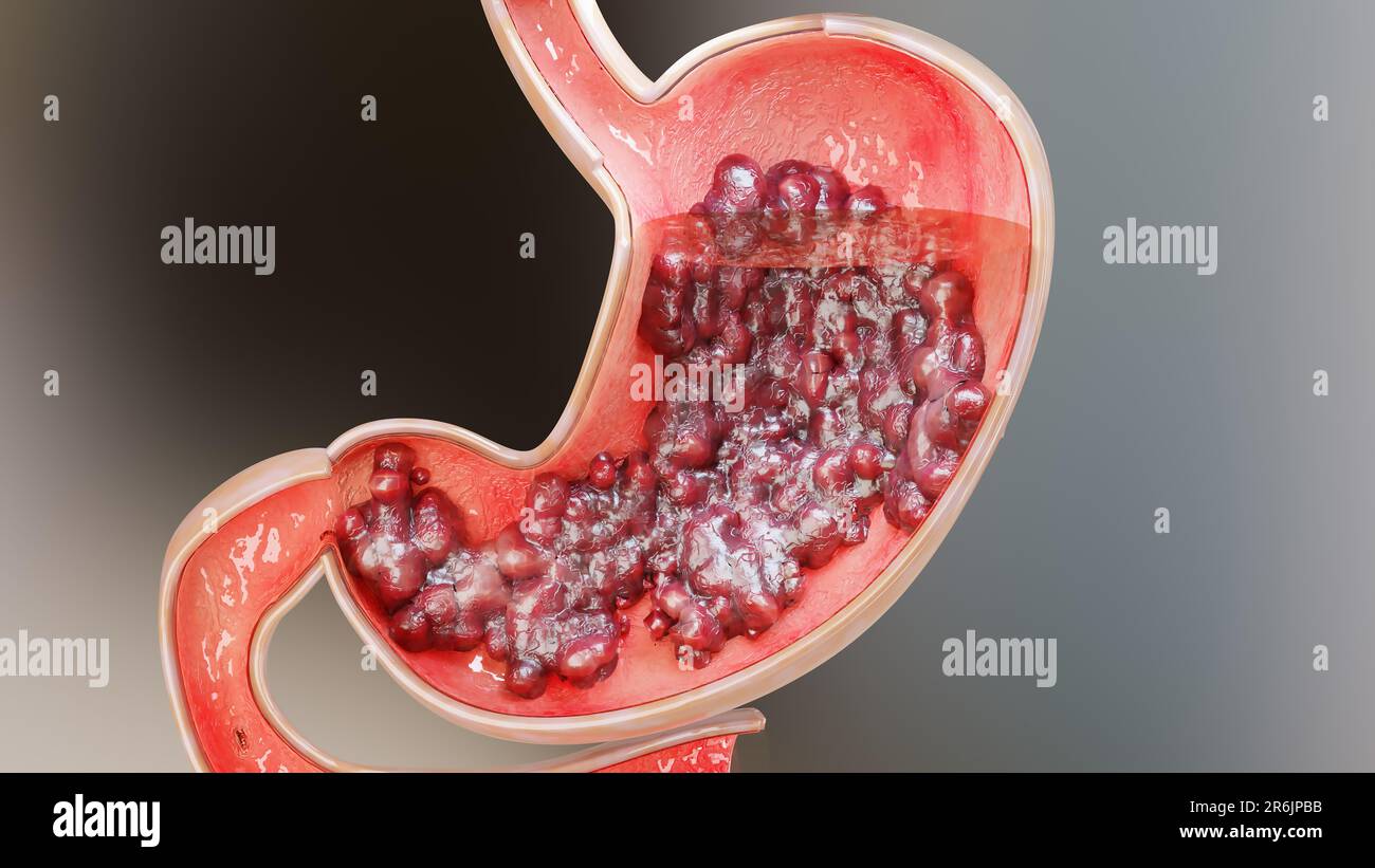 Stomach cancer. stages tumor growth in digestive system, Peptic Ulcer ...