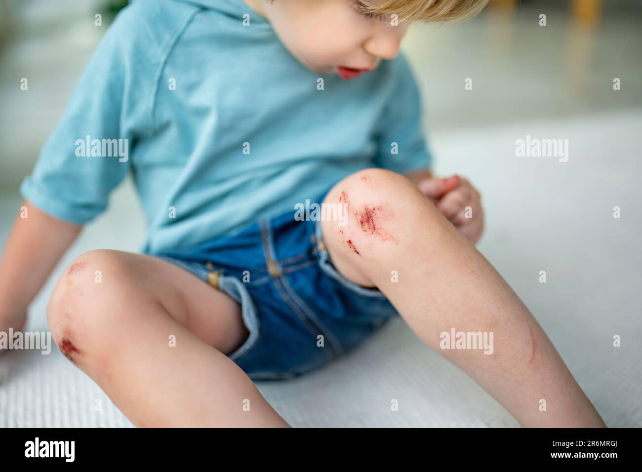 Toddler boy with sore scraped knees. Parent helping her child perform ...