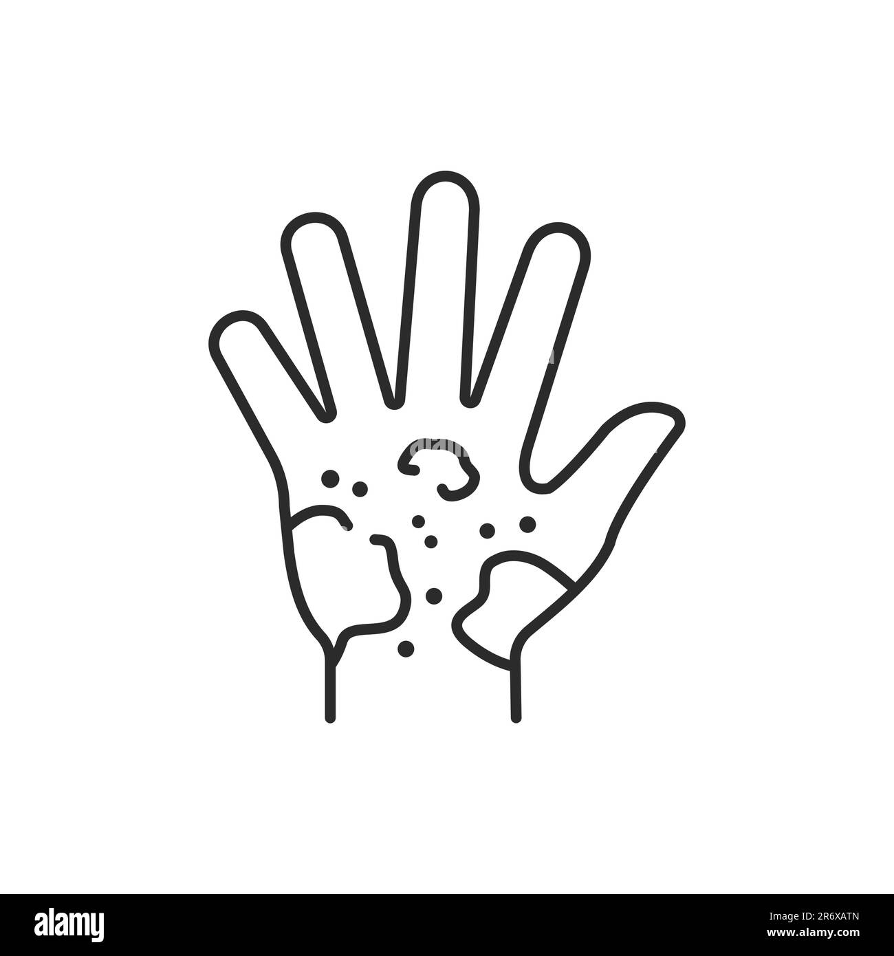 Urticaria illustration Black and White Stock Photos & Images - Alamy