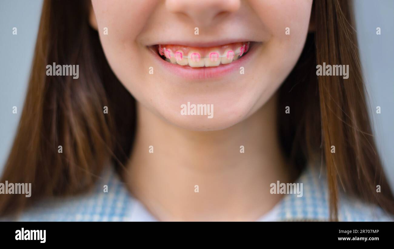 girl with correct bite - Orthodontic Treatment. Dental Care Concept ...