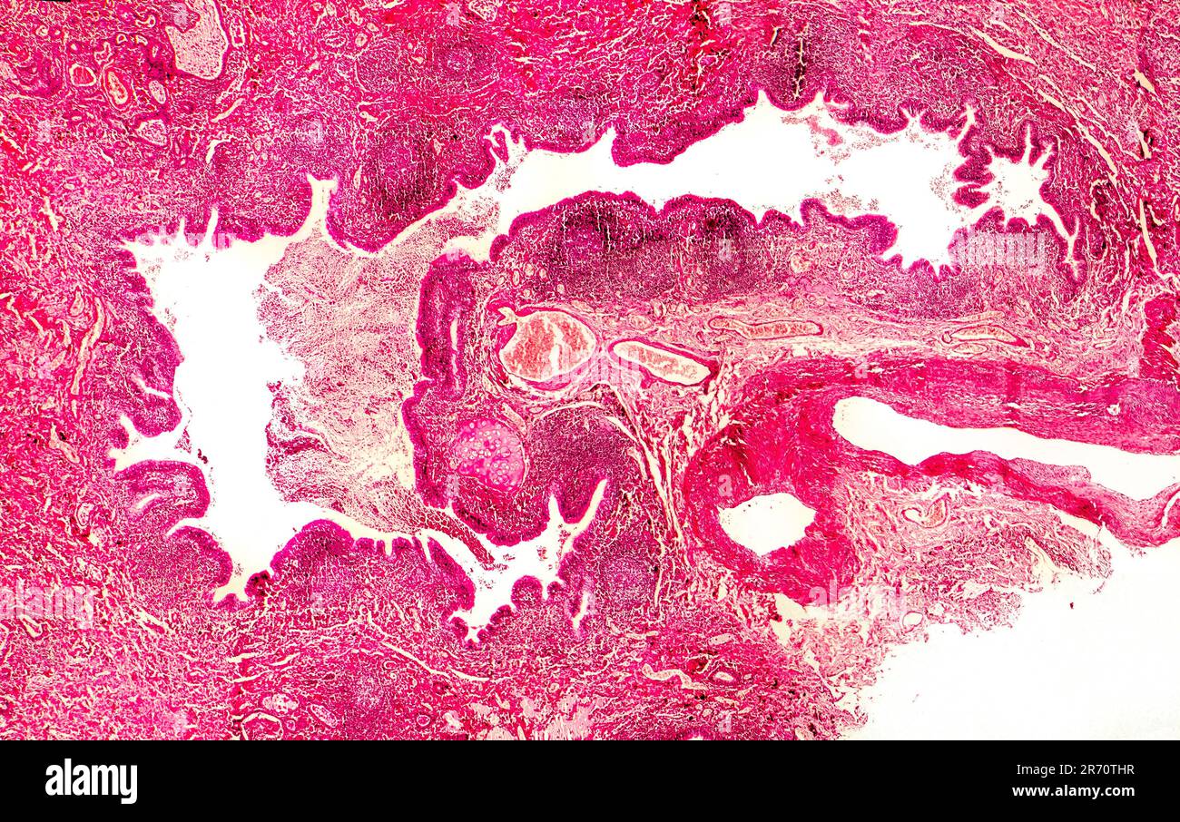 Bronchiectasis, cross-section through bronchus. Light photomicrograph ...