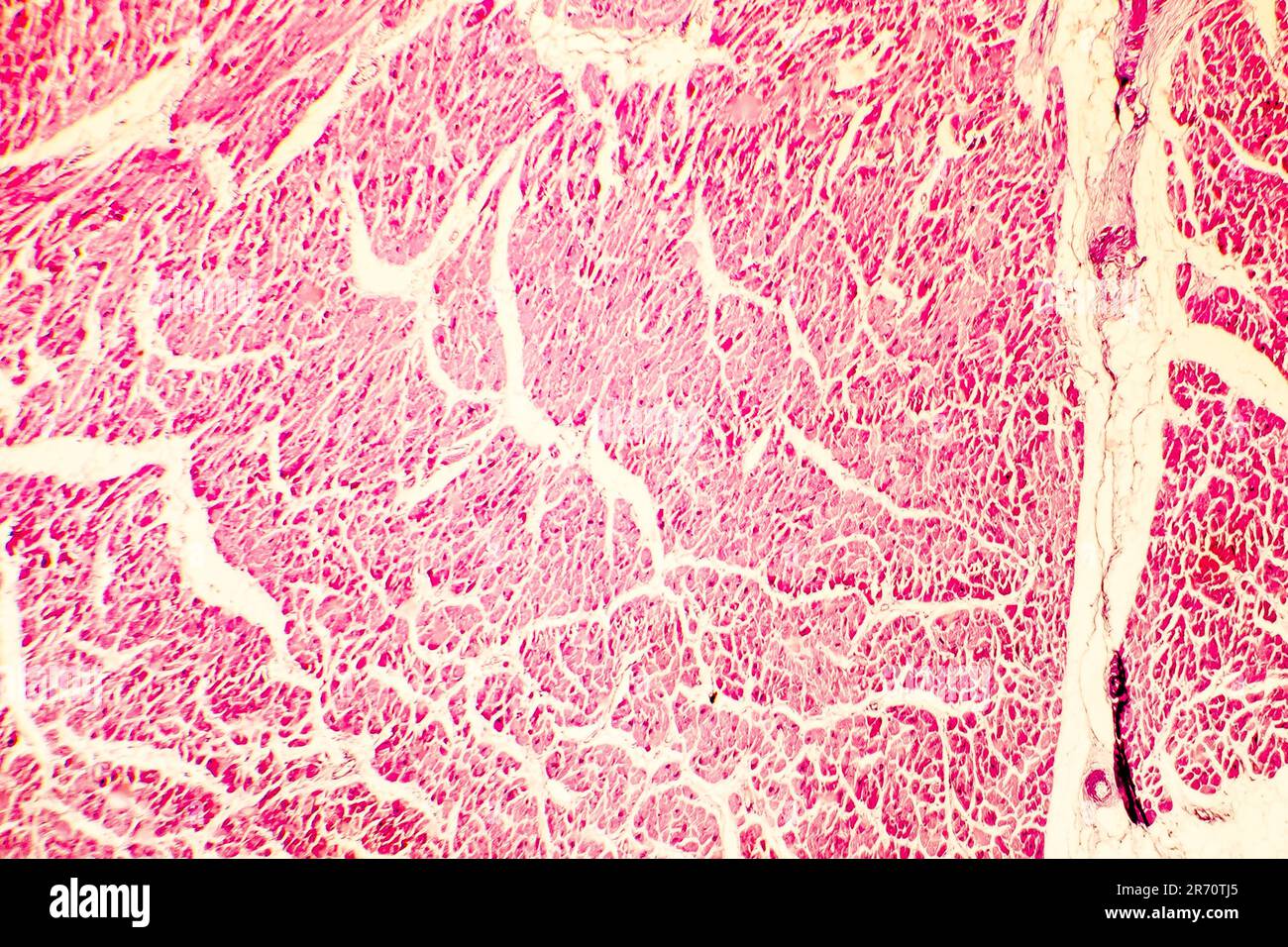 Heart hypertrophy. Photomicrograph showing hypertrophic myocardium with ...