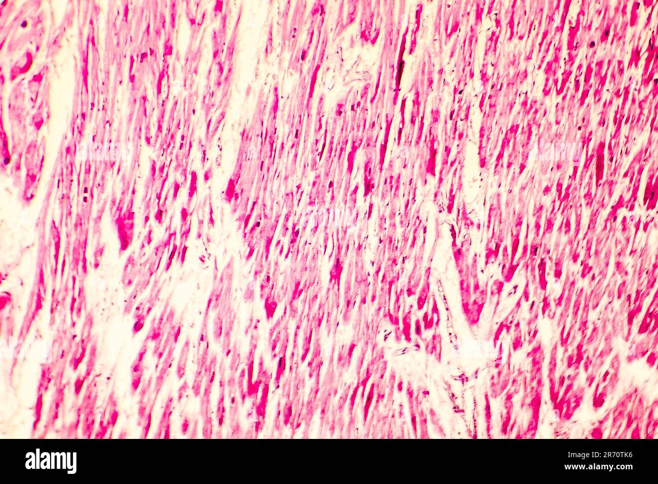 Heart hypertrophy. Photomicrograph showing hypertrophic myocardium with ...