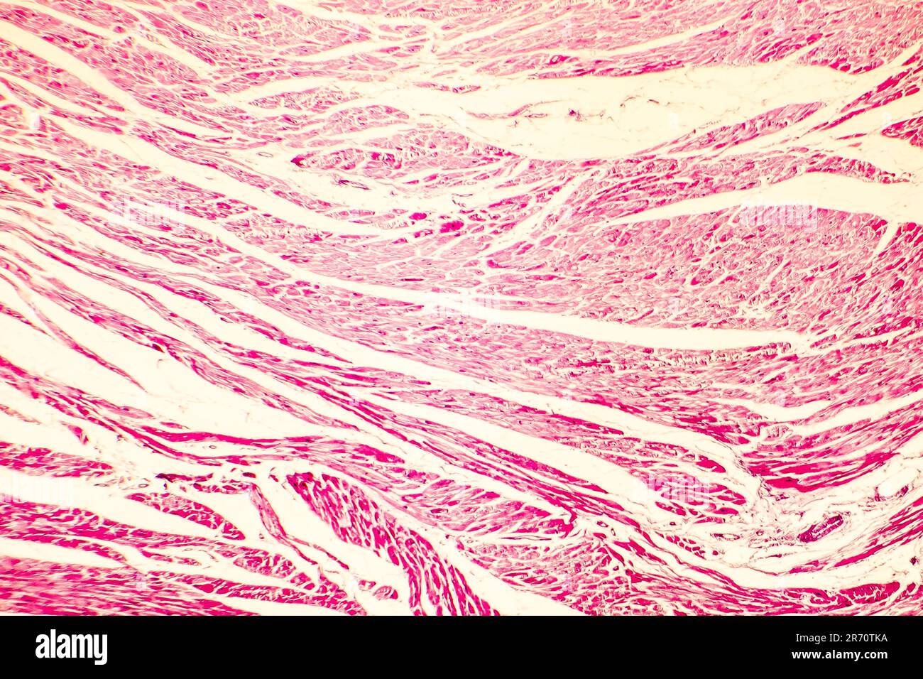 Heart hypertrophy. Photomicrograph showing hypertrophic myocardium with ...