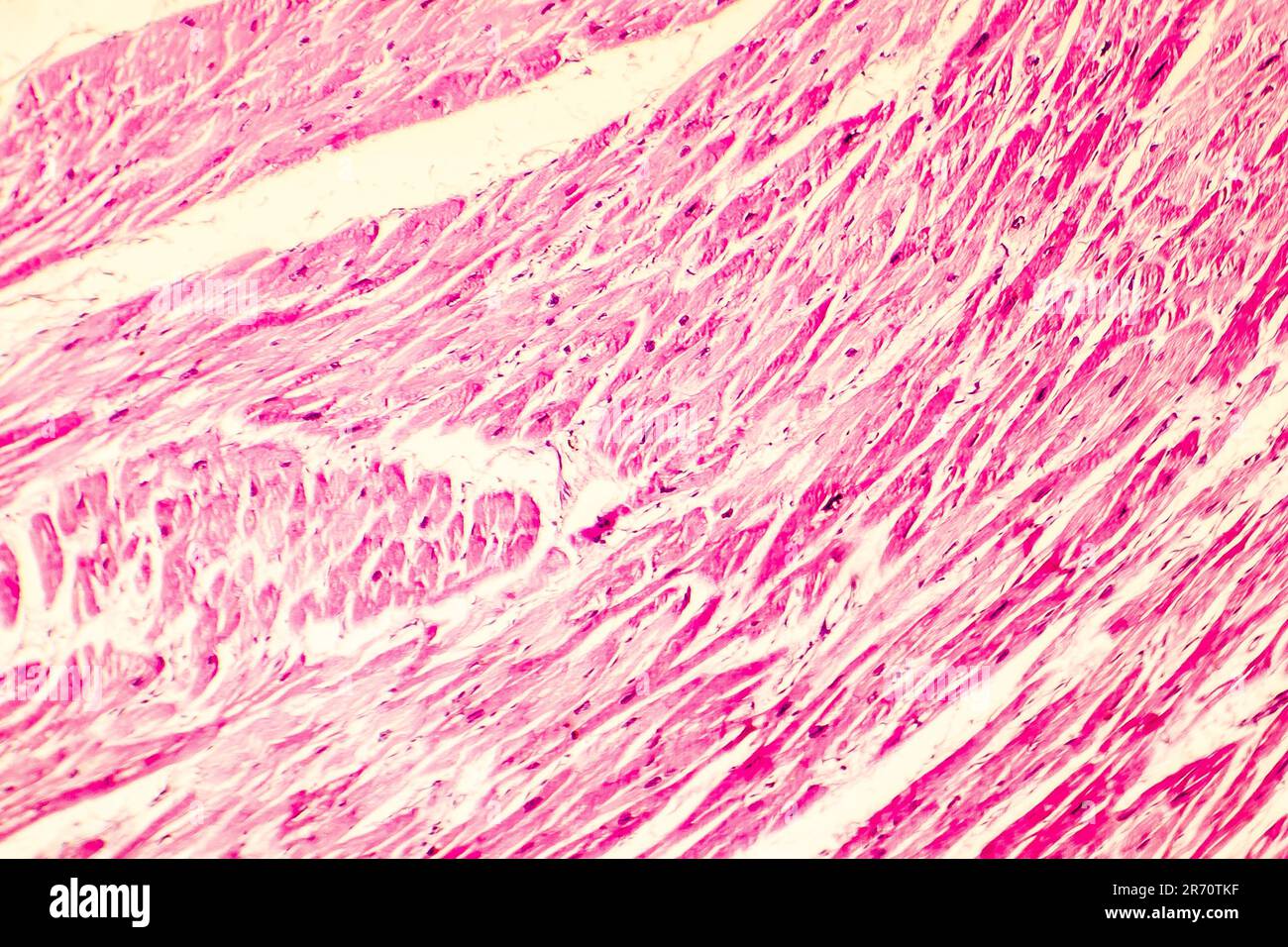 Heart hypertrophy. Photomicrograph showing hypertrophic myocardium with ...