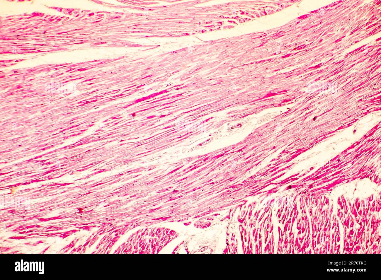 Heart hypertrophy. Photomicrograph showing hypertrophic myocardium with ...