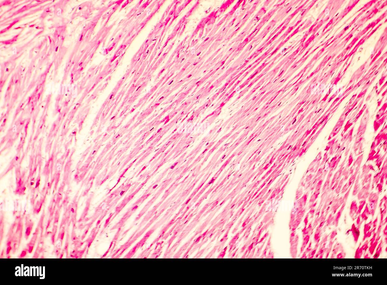 Heart hypertrophy. Photomicrograph showing hypertrophic myocardium with ...