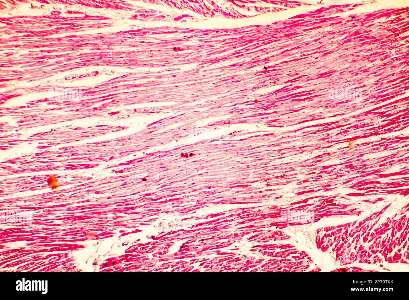 Heart hypertrophy. Photomicrograph showing hypertrophic myocardium with ...