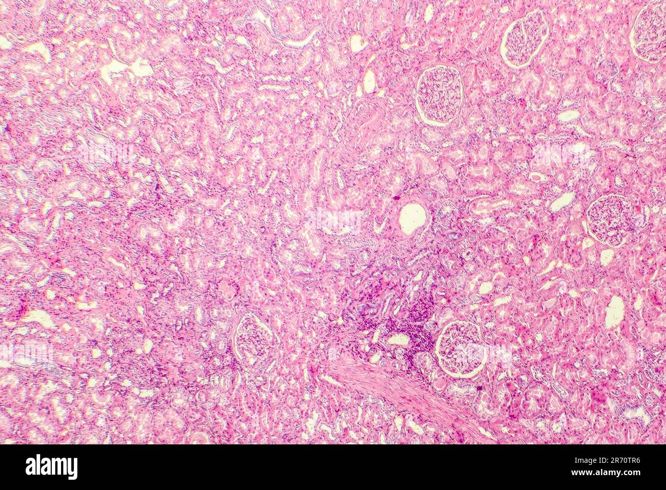 Hyaline degeneration of renal artery, light photomicrograph Stock Photo ...