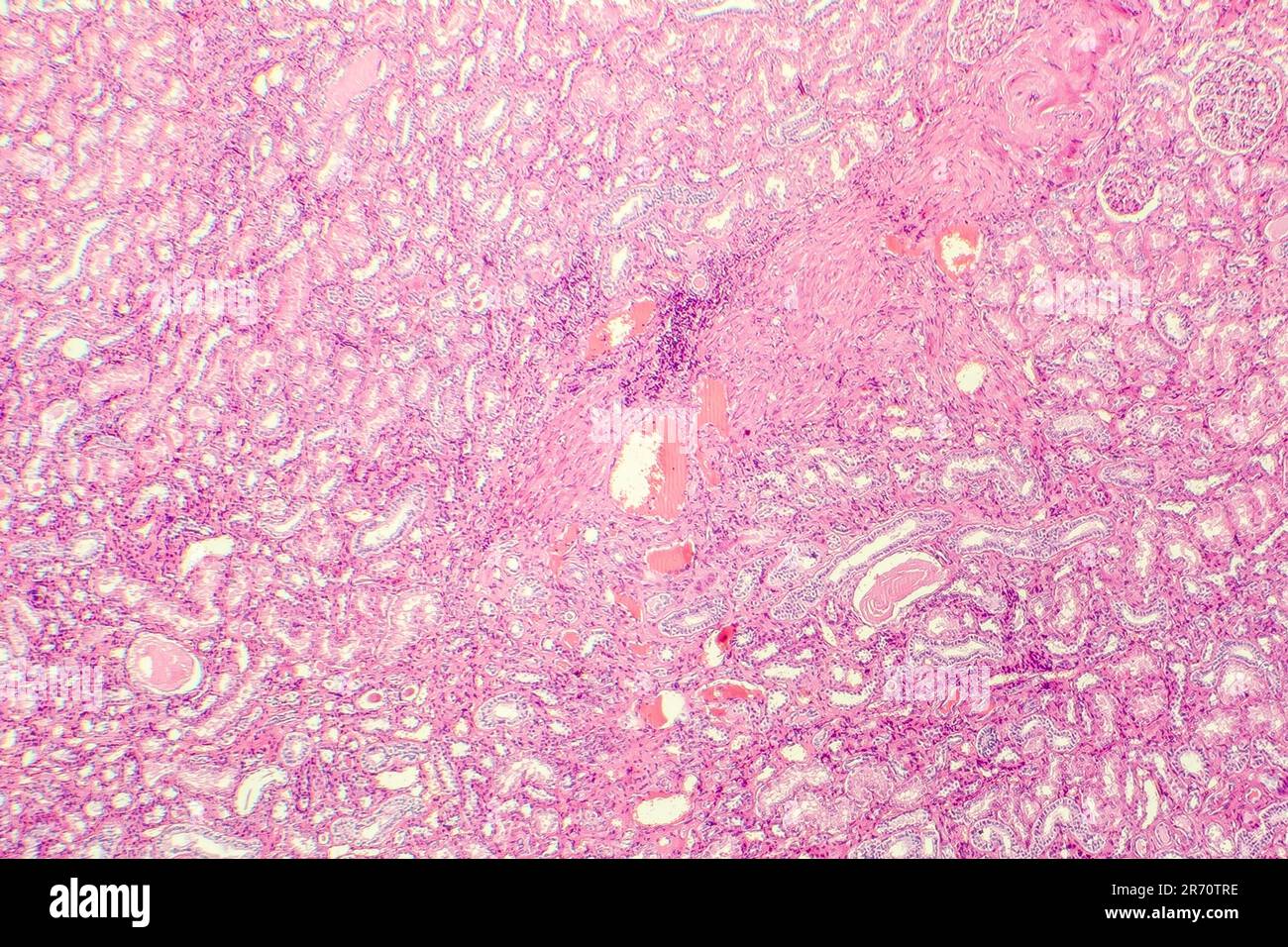 Hyalinosis hi-res stock photography and images - Alamy