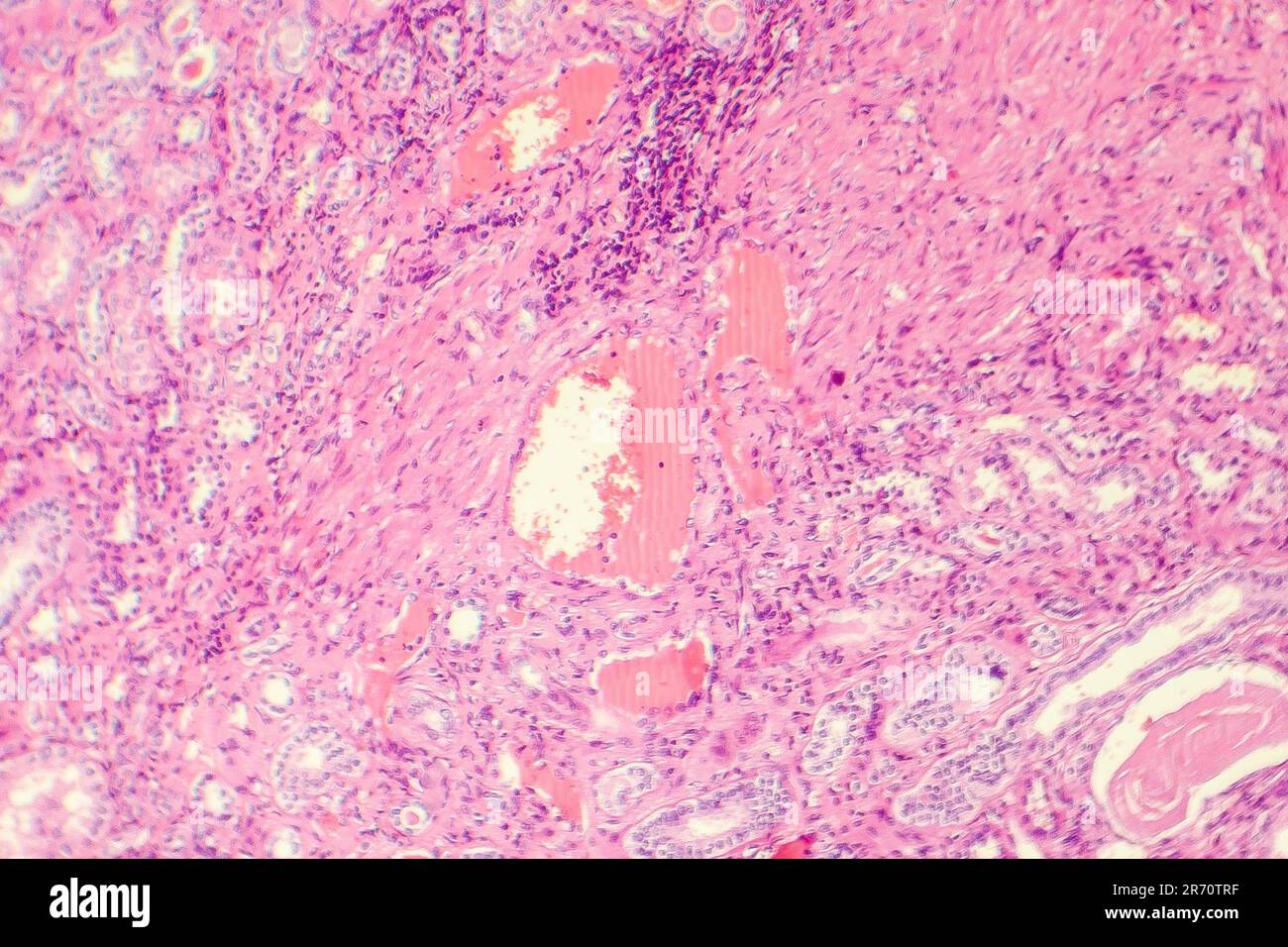 Hyaline degeneration of renal artery, light photomicrograph Stock Photo ...