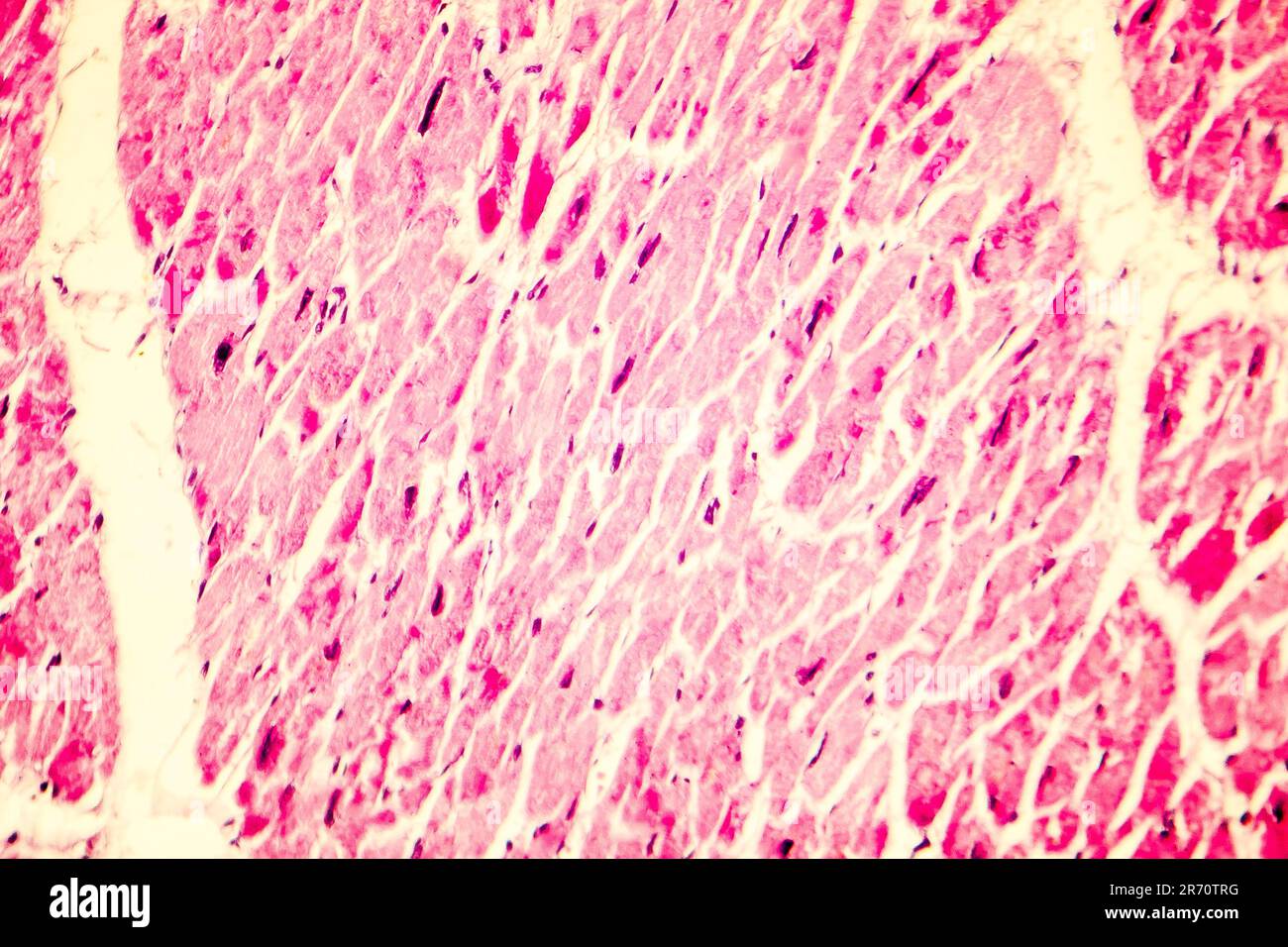 Heart hypertrophy. Photomicrograph showing hypertrophic myocardium with ...