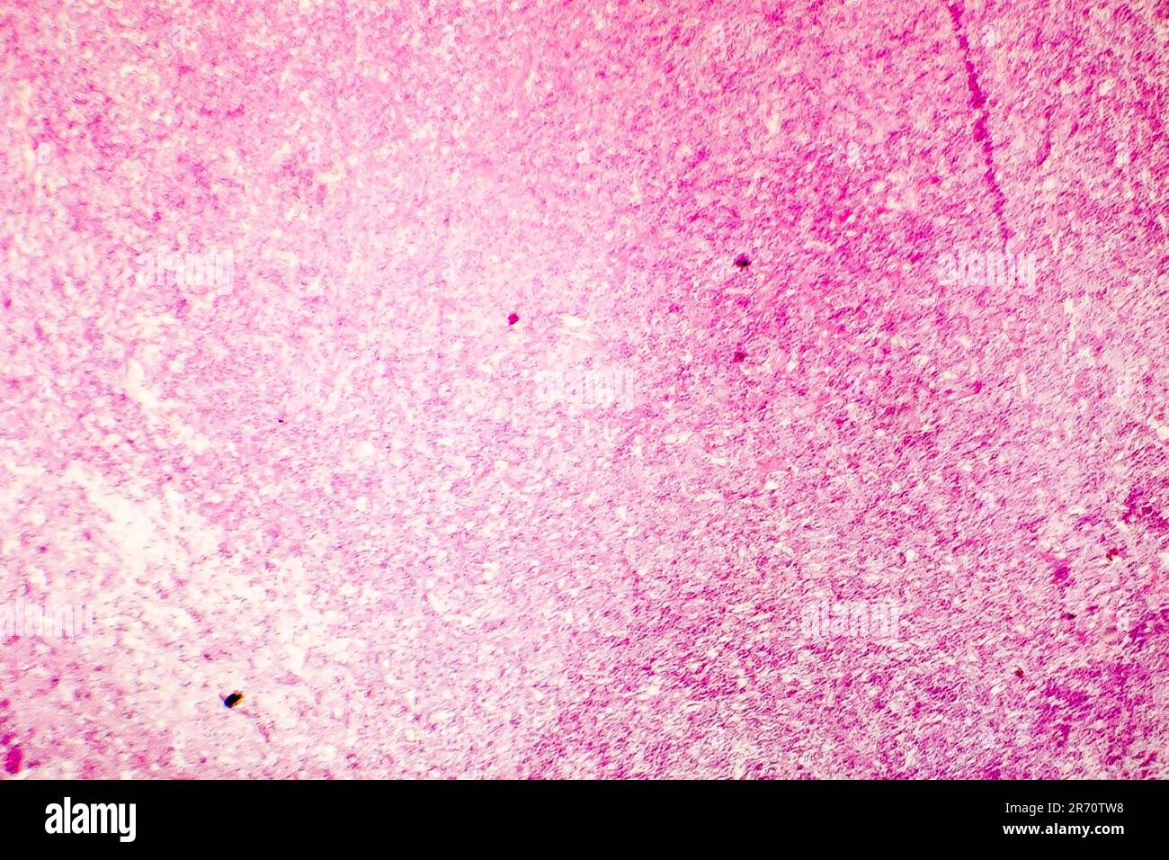 Liquefactive necrosis of the human brain, light photomicrograph showing ...
