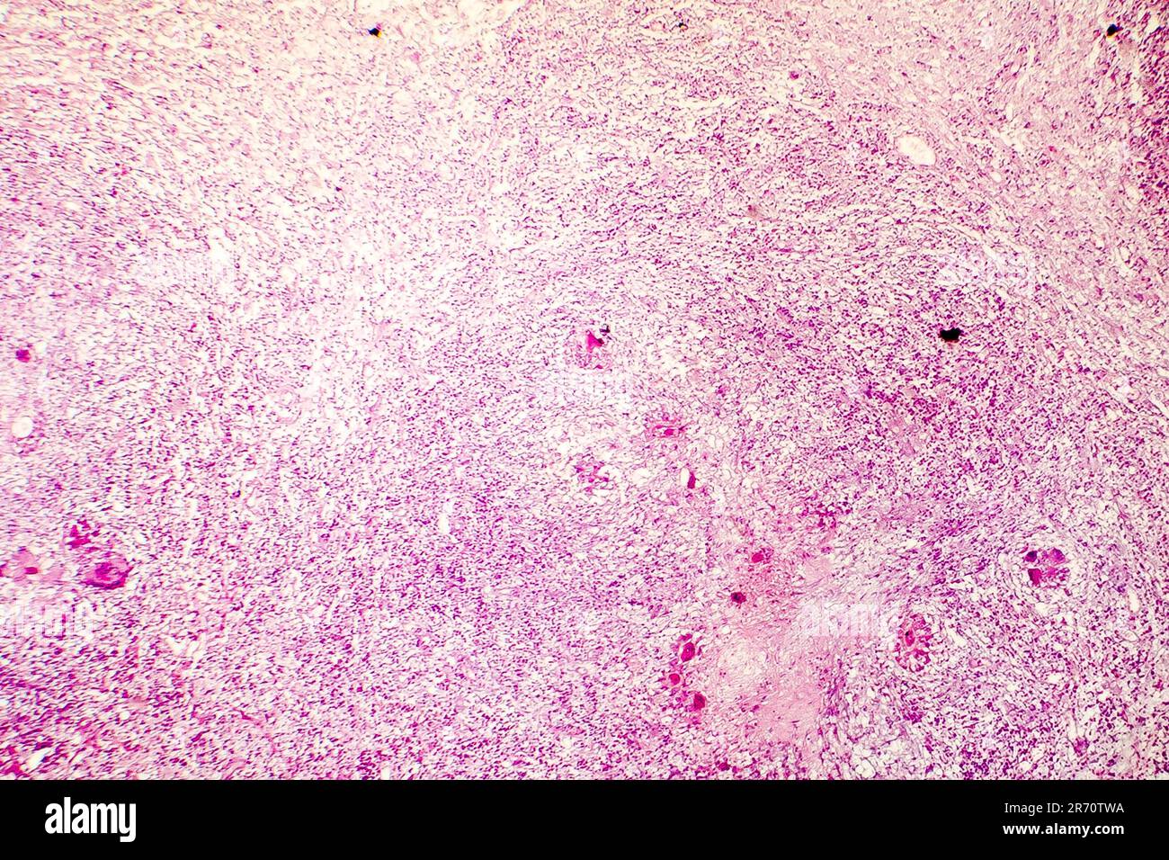 Liquefactive necrosis of the human brain, light photomicrograph showing ...
