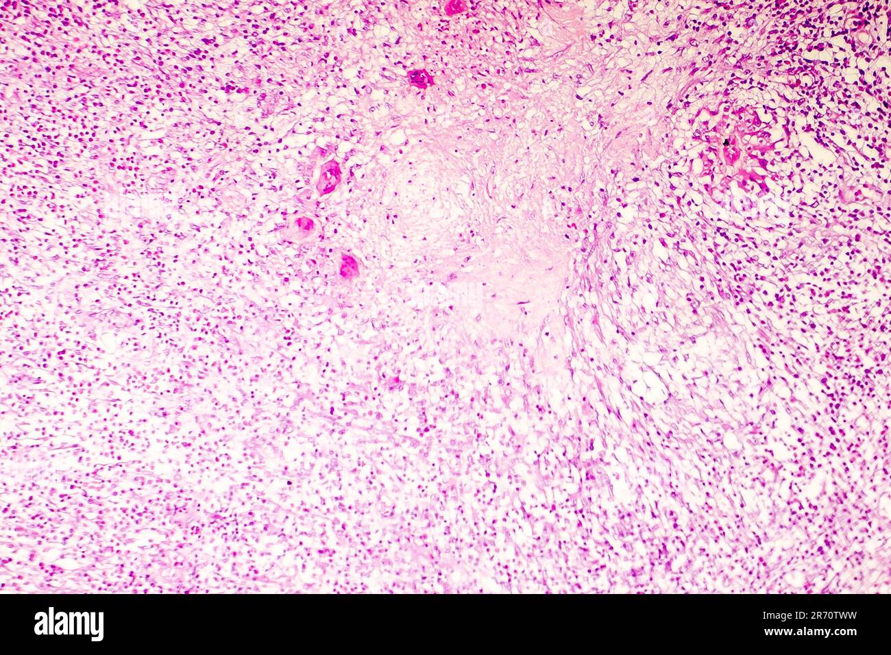 Liquefactive necrosis of the human brain, light photomicrograph showing ...