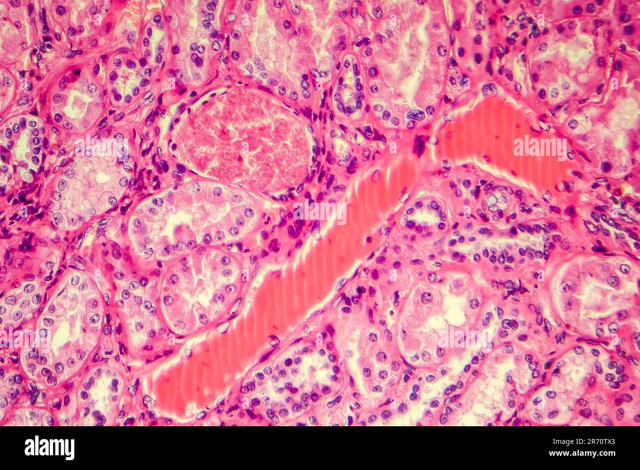 Hyaline degeneration of renal artery, light photomicrograph Stock Photo ...
