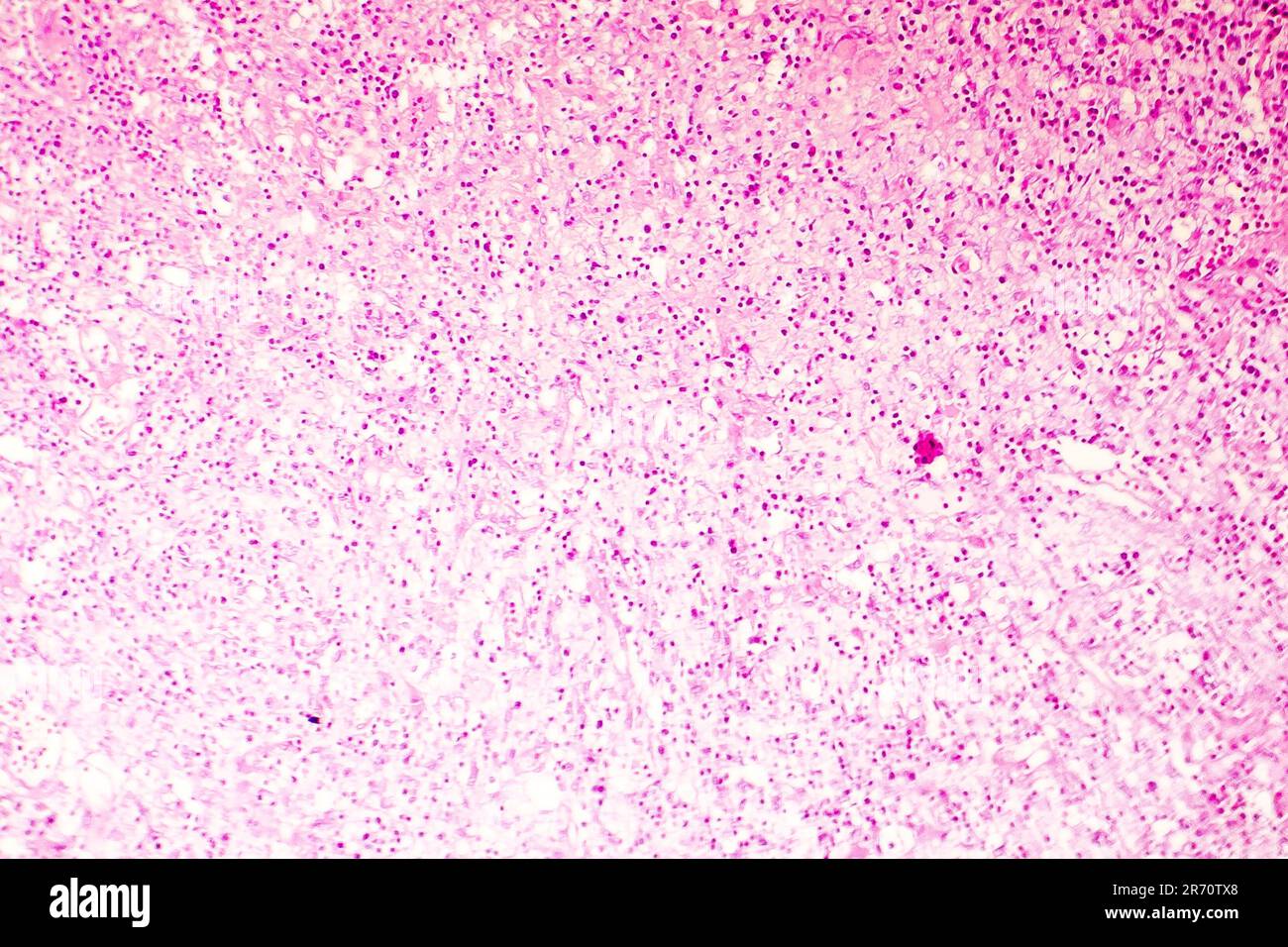 Liquefactive necrosis of the human brain, light photomicrograph showing ...
