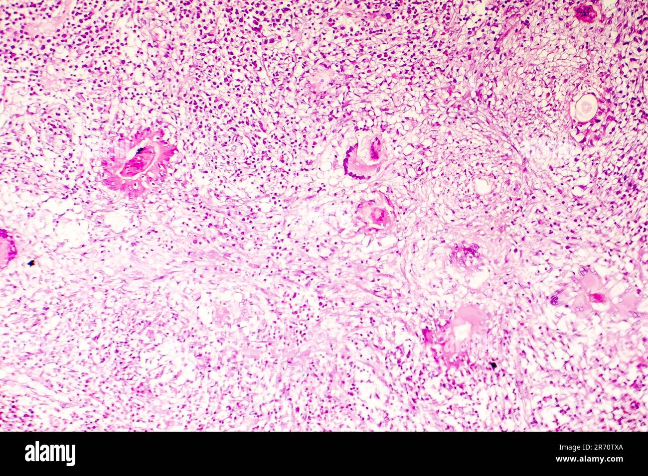 Liquefactive necrosis of the human brain, light photomicrograph showing ...