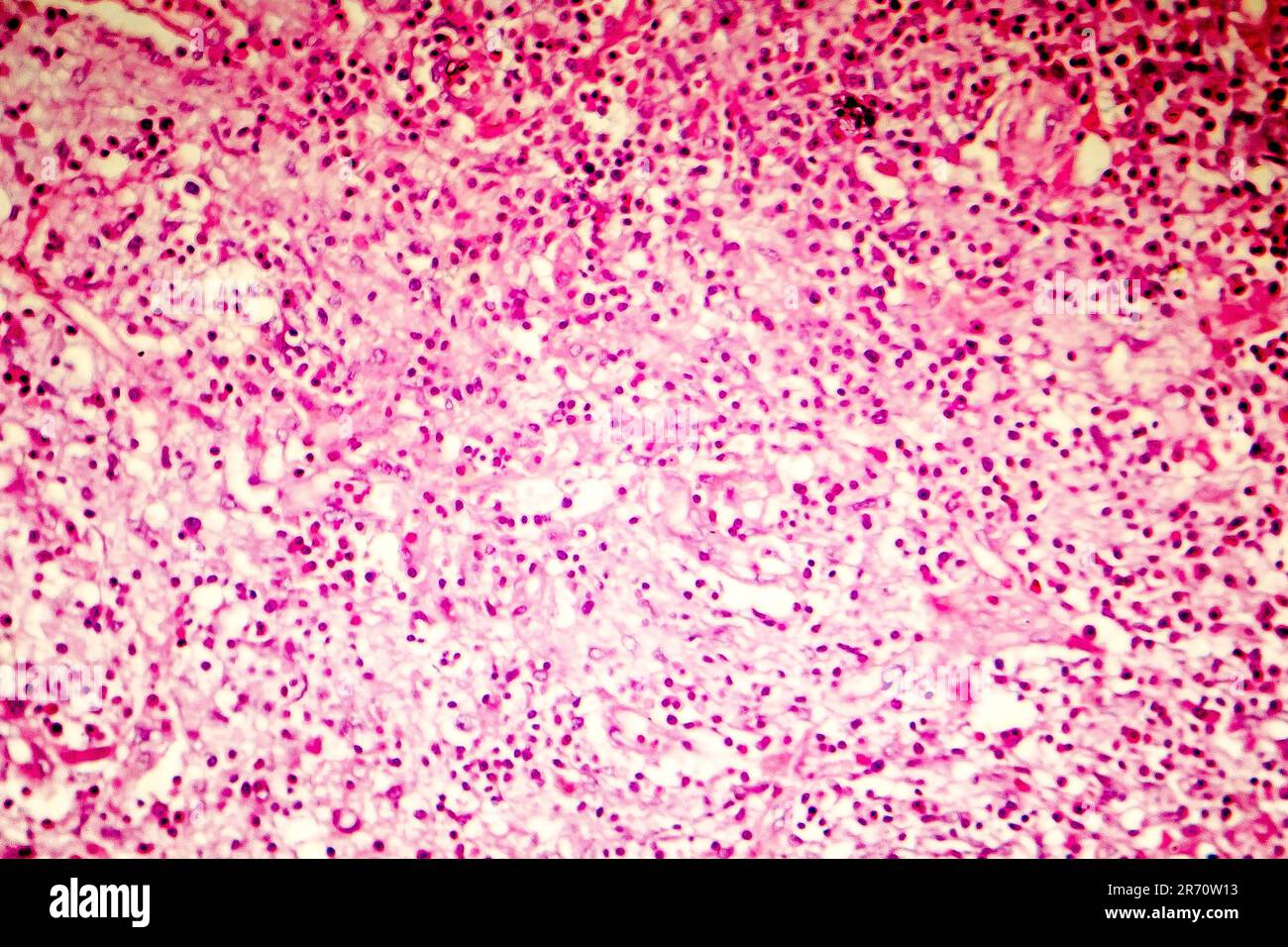 Liquefactive necrosis of the human brain, light photomicrograph showing ...