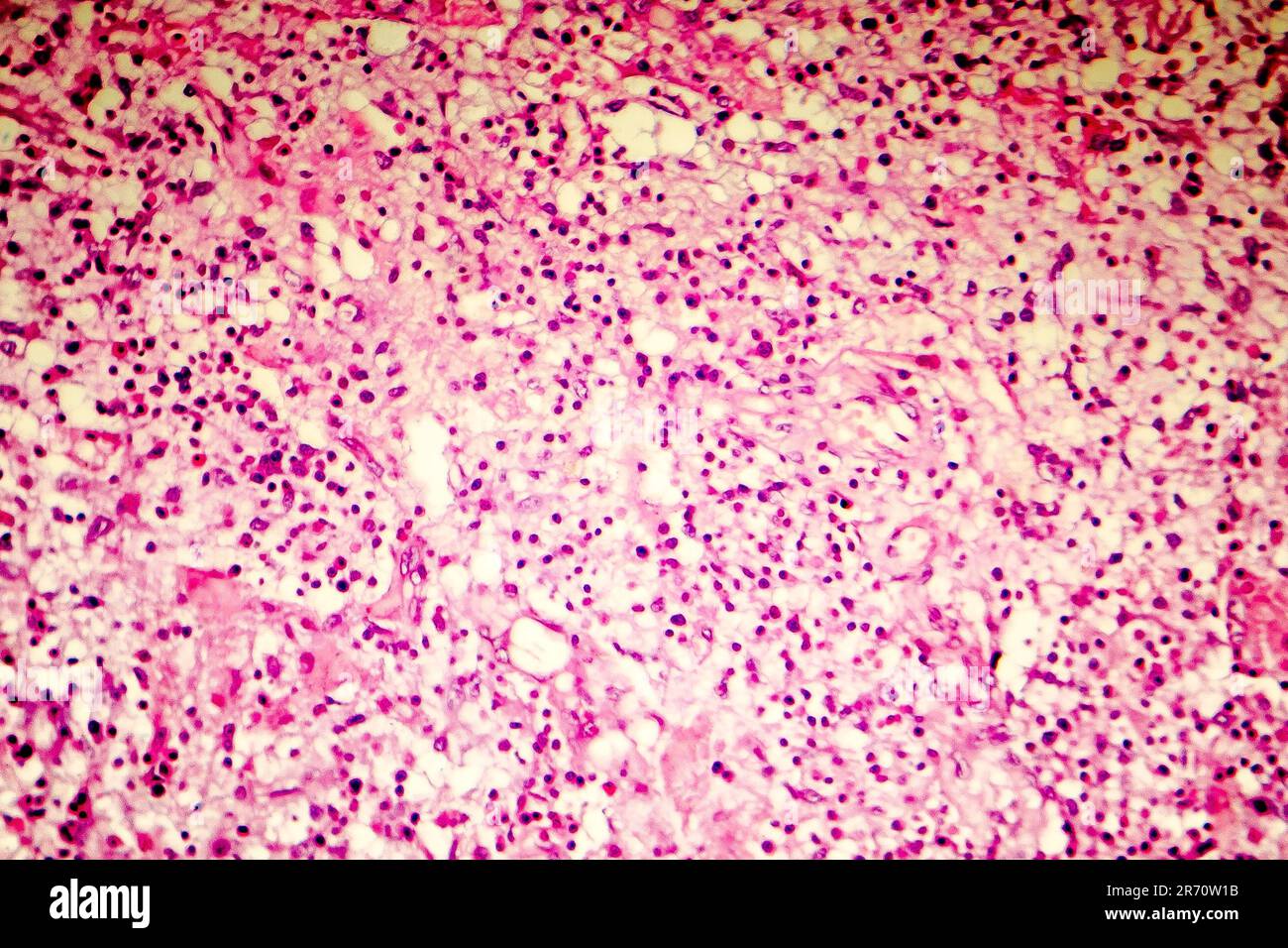 Liquefactive Necrosis Of The Human Brain Light Photomicrograph Showing Loss Of Cell Outlines
