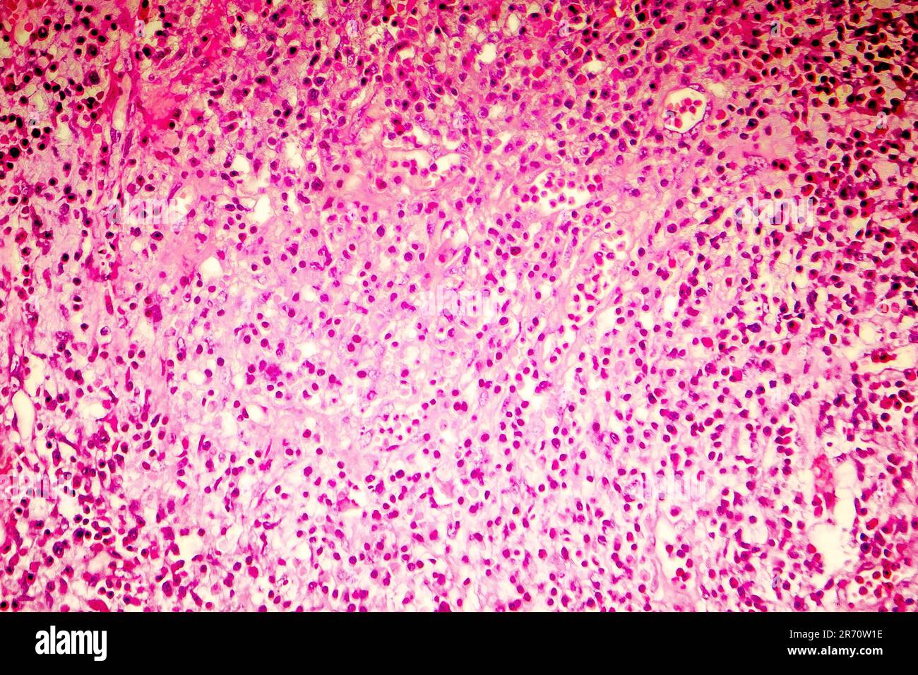 Liquefactive necrosis of the human brain, light photomicrograph showing ...